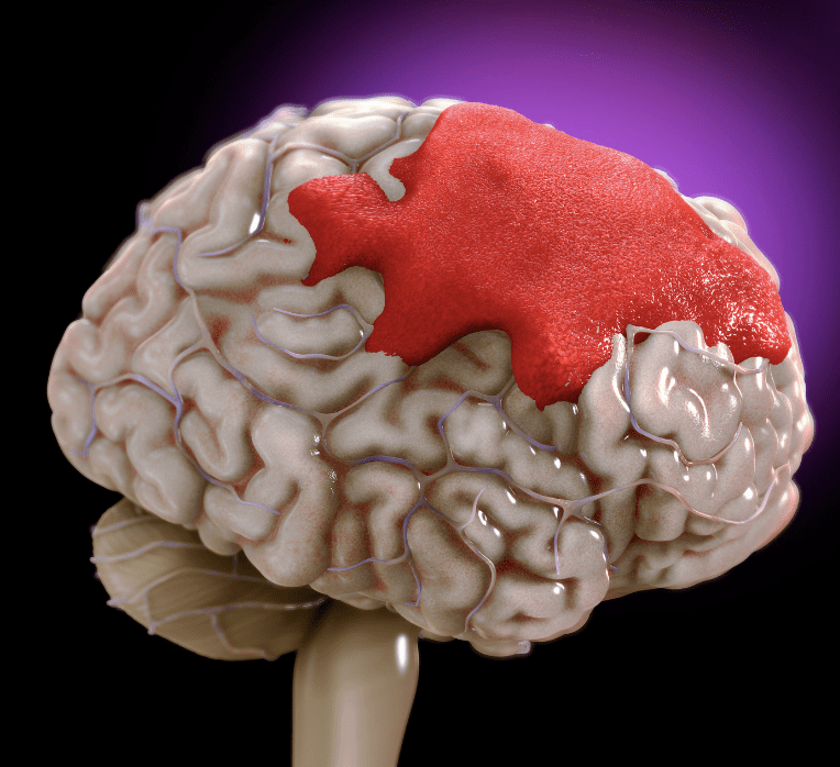 How Serious a Brain Bleed is After a Car Accident: A Must-Read